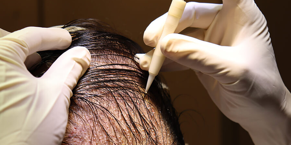 The Advantages of the DHI Hair Transplant Method