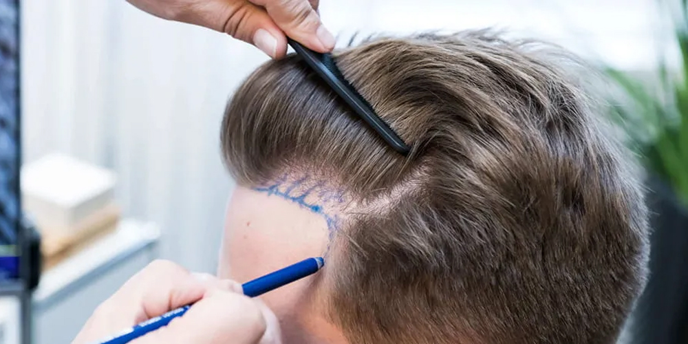 The Advantages of the DHI Hair Transplant Method